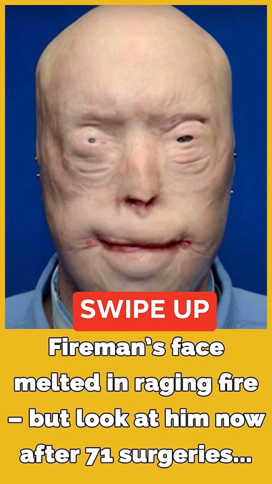 Firefighter has face transplant after third-degree burns & survives ...